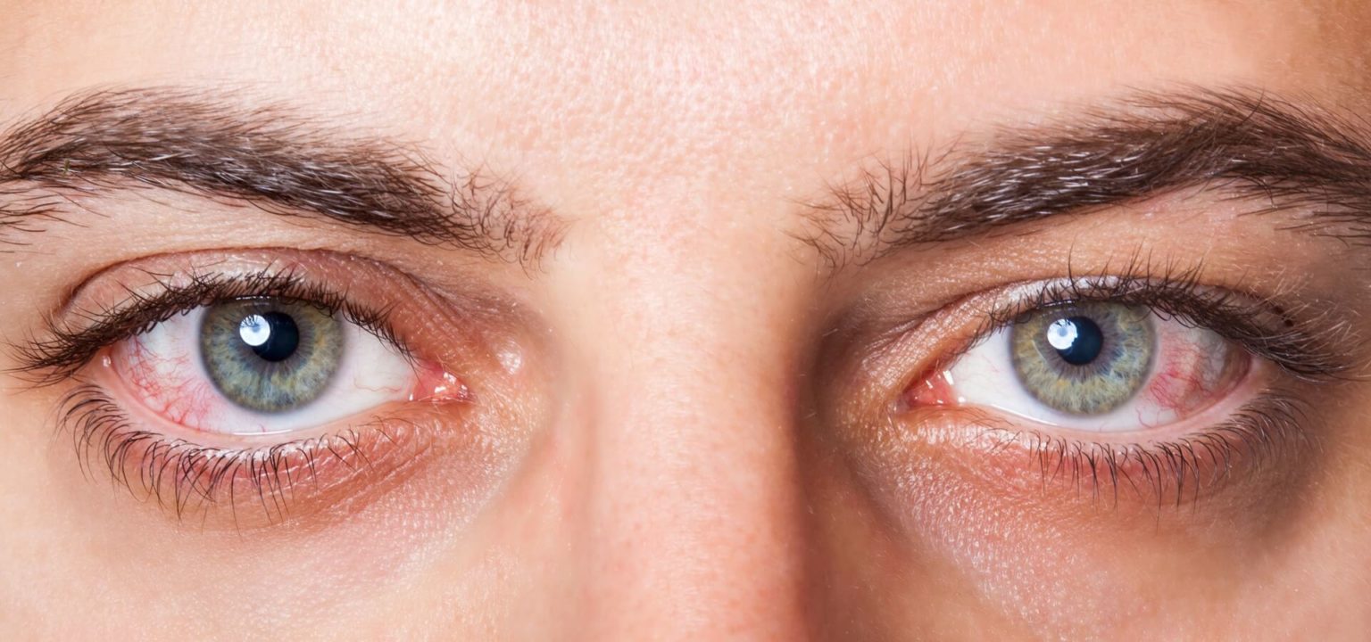 The 5 Most Common Eye Infections (And How To Avoid Them)