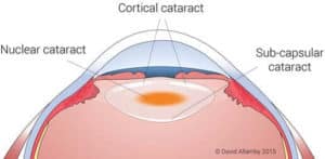 Cataract Surgery Patients Guide | Focus Clinics