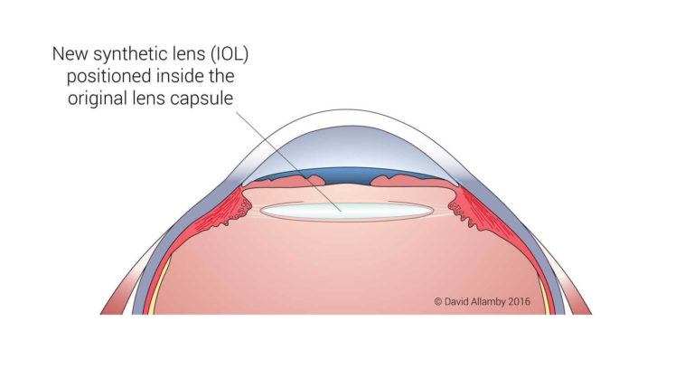 Cataract Surgery Patients Guide | Focus Clinics
