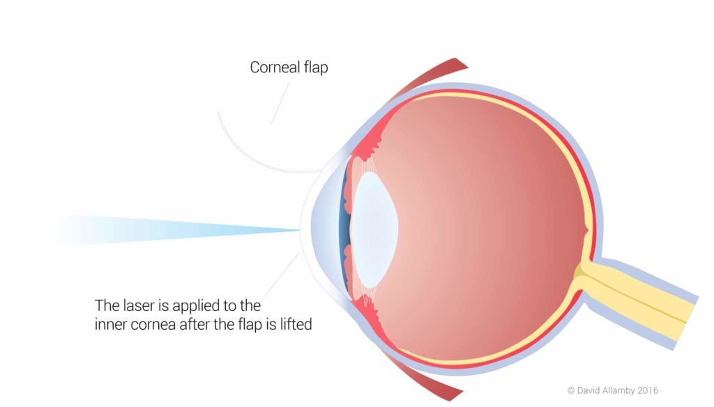 How Does Laser Eye Surgery Work? | Focus Clinics